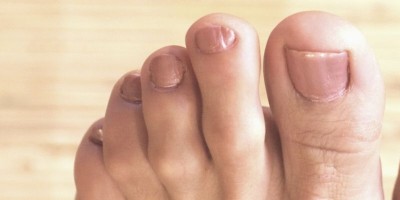 Your Weird Pinky Toenail (And You're Not Alone!) - Uglee Feet